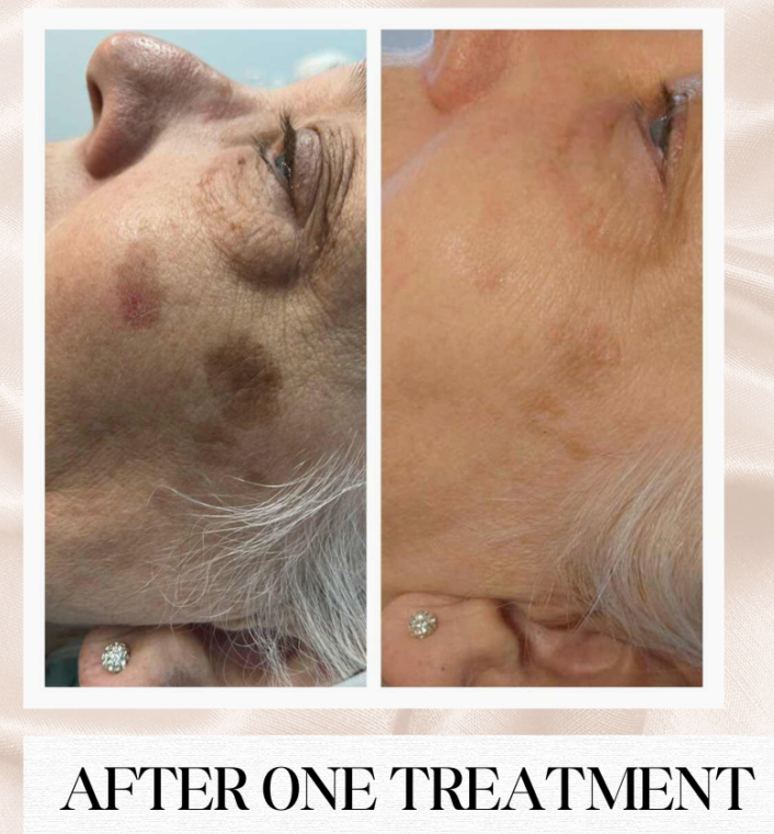 Laser Hyper-Pigmentation Treatment at Surrey, MN SPA